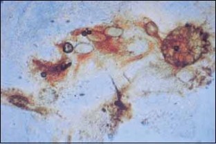 Diagnosis and Treatment of Scabies | SpringerLink