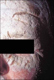 Diagnosis and Treatment of Scabies | SpringerLink