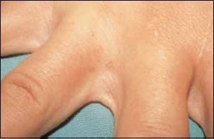 Diagnosis and Treatment of Scabies | SpringerLink