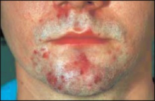 Treatment of Gram-Negative Folliculitis in Patients with Acne ...