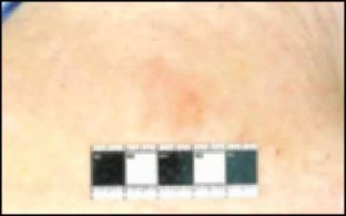 Skin-Related Complications of Insulin Therapy | SpringerLink