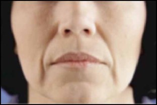 The Wrinkle Severity Rating Scale | SpringerLink