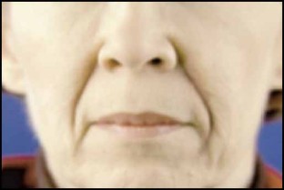 The Wrinkle Severity Rating Scale | SpringerLink