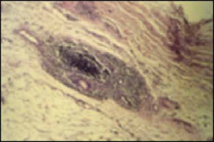 Localized Panniculitis and Subsequent Lipoatrophy with Subcutaneous ...