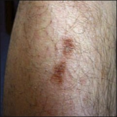 Manifestations of Cutaneous Diabetic Microangiopathy | SpringerLink