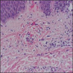 Manifestations of Cutaneous Diabetic Microangiopathy | SpringerLink