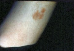 Manifestations of Cutaneous Diabetic Microangiopathy | SpringerLink
