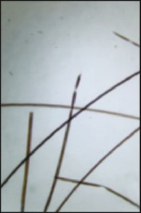 Monilethrix | SpringerLink