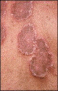 Cutaneous Manifestations of Syphilis | SpringerLink