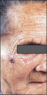 Role of UV Light in Photodamage, Skin Aging, and Skin Cancer | SpringerLink