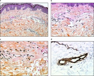 Cutaneous Collagenous Vasculopathy | SpringerLink