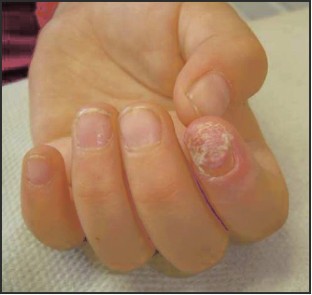 Nail Disorders in Children | SpringerLink