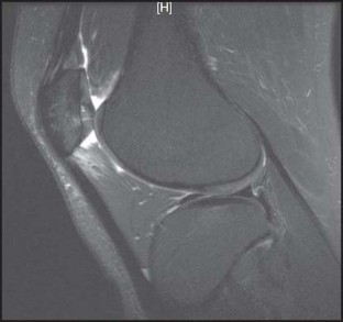 Evaluation and Treatment of Disorders of the Infrapatellar Fat Pad ...