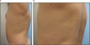 Paraneoplastic Erythema Annulare Centrifugum Eruption: PEACE | SpringerLink