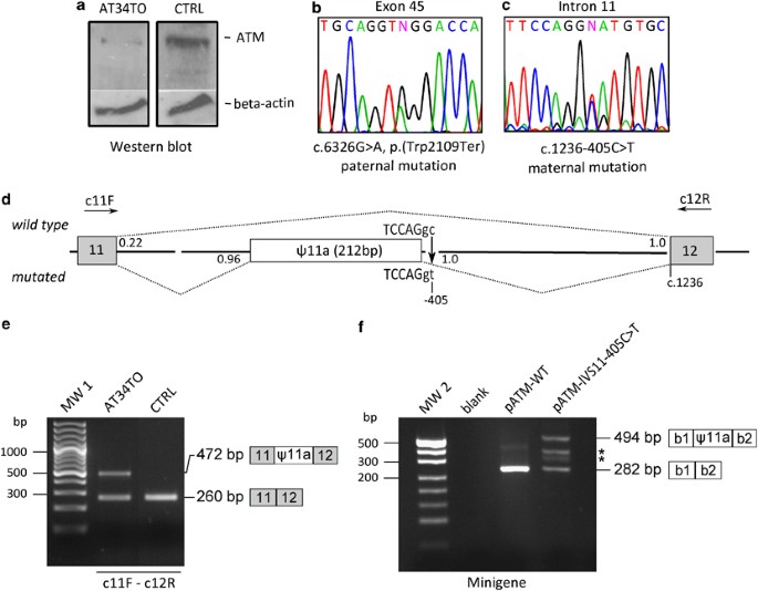 Deep-intronic ATM mutation detected by genomic resequencing and ...