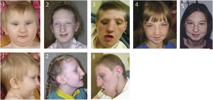 Molecular and clinical delineation of the 17q22 microdeletion phenotype ...