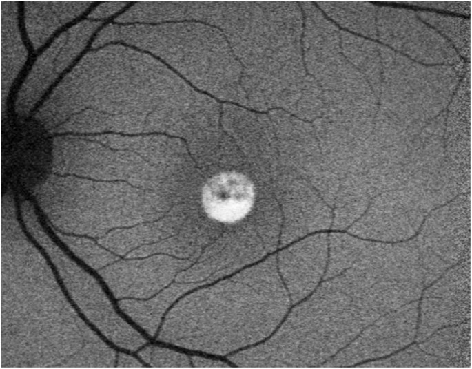 Why the macula? | Eye
