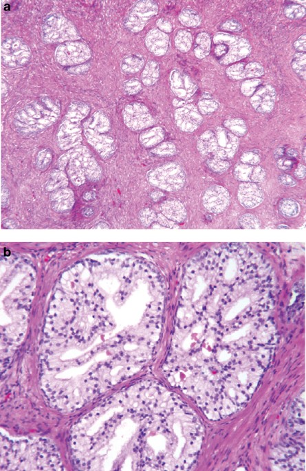 Benign mimickers of prostatic adenocarcinoma | Modern Pathology
