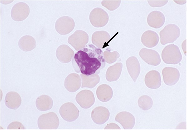 Characteristic peripheral blood findings in human ehrlichiosis | Modern ...