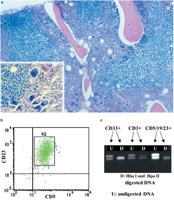 Increased incidence of monoclonal B-cell infiltrate in chronic ...