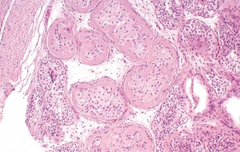 Sex cord-stromal tumors of the ovary and testis: their similarities and ...