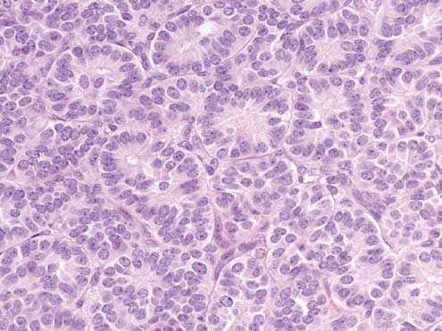 Sex cord-stromal tumors of the ovary and testis: their similarities and ...