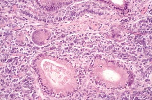 Sex cord-stromal tumors of the ovary and testis: their similarities and ...