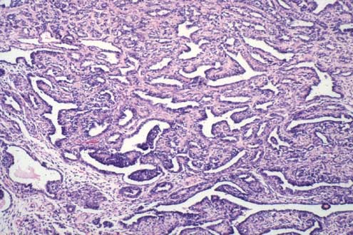 Sex cord-stromal tumors of the ovary and testis: their similarities and ...