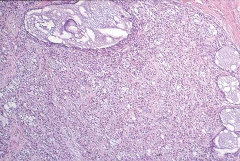 Sex cord-stromal tumors of the ovary and testis: their similarities and ...