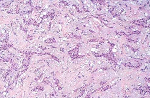 Sex cord-stromal tumors of the ovary and testis: their similarities and ...