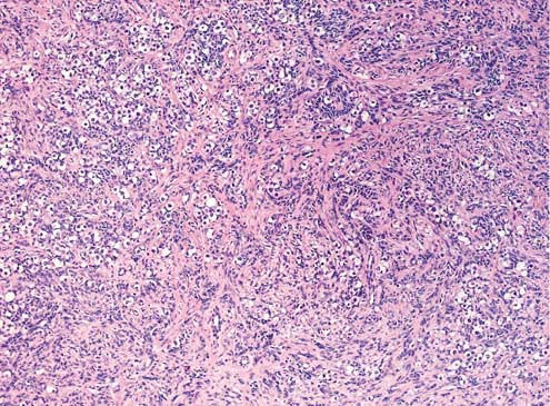 Sex cord-stromal tumors of the ovary and testis: their similarities and ...