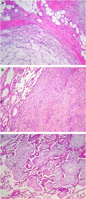 Distant metastasis in retroperitoneal dedifferentiated liposarcoma is ...