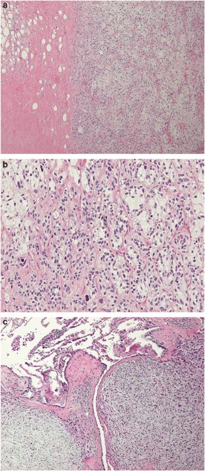 Distant metastasis in retroperitoneal dedifferentiated liposarcoma is ...