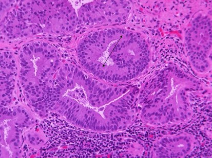 Molecular alterations in columnar cell lesions of the breast | Modern ...