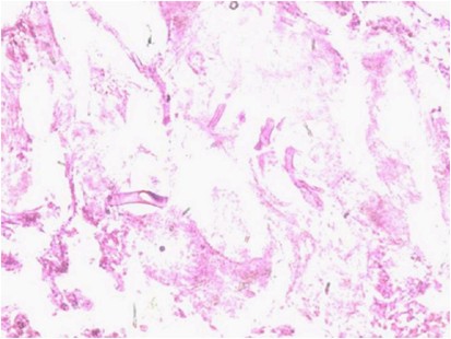 Zygomycotic necrotizing fasciitis in immunocompetent patients: a series ...