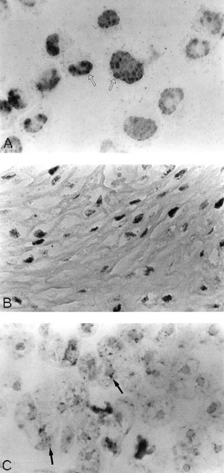 “High Risk” HPV Types Are Frequently Detected in Potentially Malignant ...