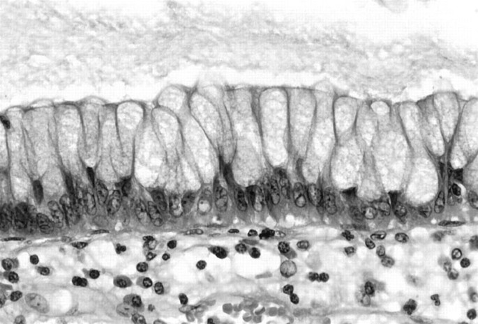Hyperplastic-Like Mucosal Change in Crohn's Disease: An Unusual Form of ...