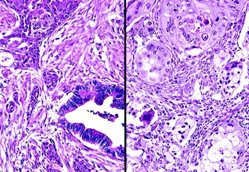 Adenosquamous Carcinoma Of The Pancreas: A Clinicopathologic Series Of 25 Cases | Modern Pathology