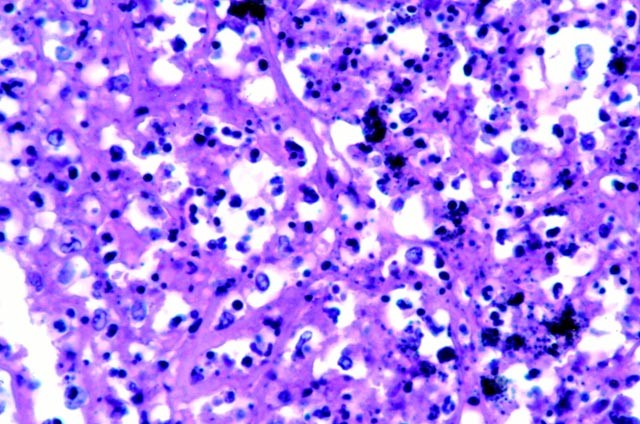 Quantitative Pathology of Inhalational Anthrax I: Quantitative ...