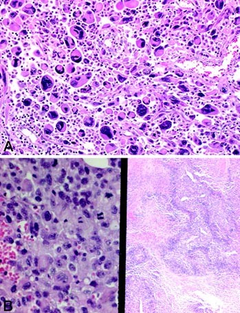 Pleomorphic Rhabdomyosarcoma in Adults: A Clinicopathologic Study of 38 ...