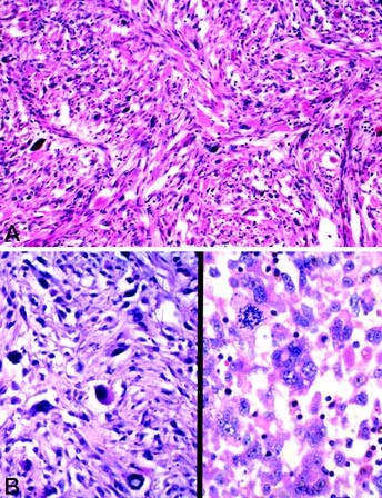 Pleomorphic Rhabdomyosarcoma in Adults: A Clinicopathologic Study of 38 ...