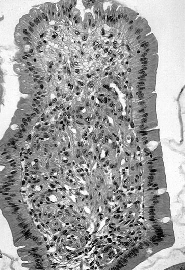 Angiogenic Polypoid Proliferation Adjacent to Ileal Carcinoid Tumors: A ...