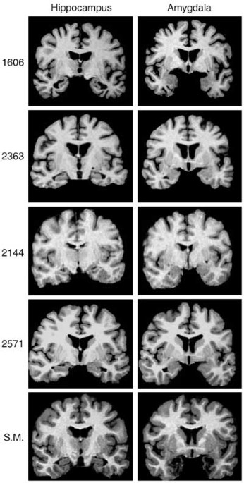Amygdala damage impairs emotional memory for gist but not details of ...