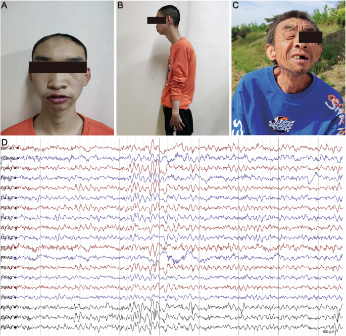 Intron retention caused by a canonical splicing variant in SSR4-related ...