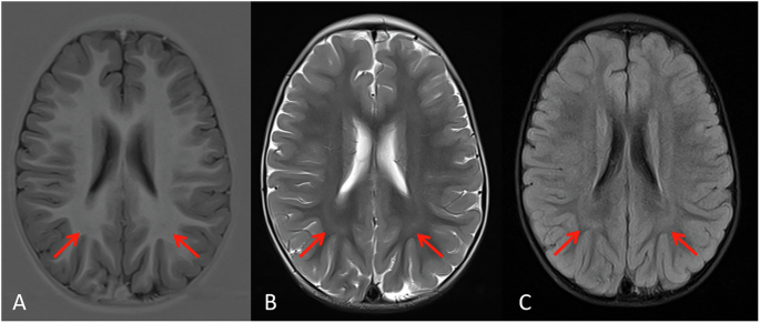 A novel homozygous COX6A1 variant causes axonal charcot-marie-tooth ...