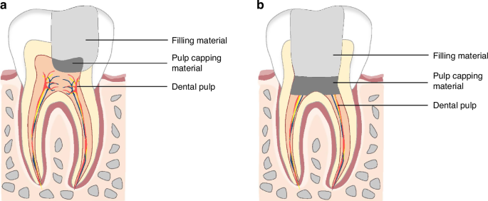 Expert consensus on pulpotomy in the management of mature permanent ...