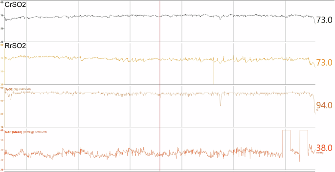 A narrative review of the clinical applications of renal NIRS and ...