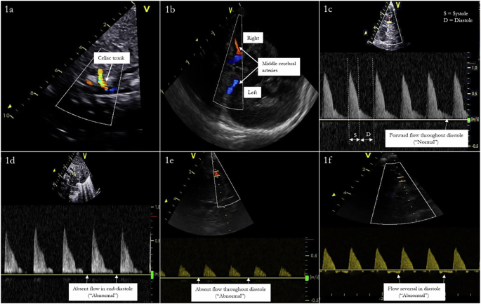 Cerebral and intestinal Doppler patterns according to patent ductus ...
