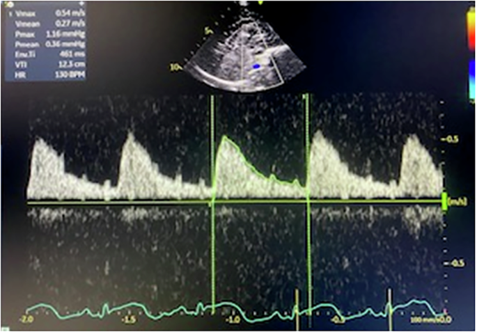 Influence of skin to skin contact on cardiac indices and cerebral ...