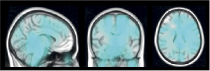 3D 7 Li magnetic resonance imaging of brain lithium distribution in ...
